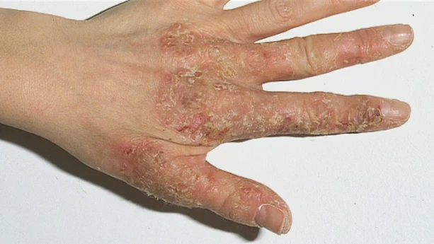 Wat is eczeem? | Schooltv