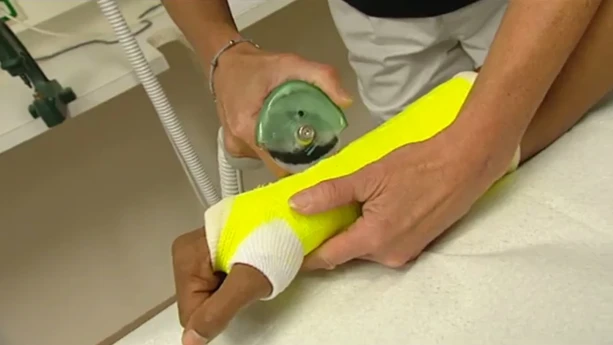 Hoe haal je het gips weer van je arm of been? | Schooltv