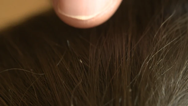 Wat is een hoofdluis? | Schooltv